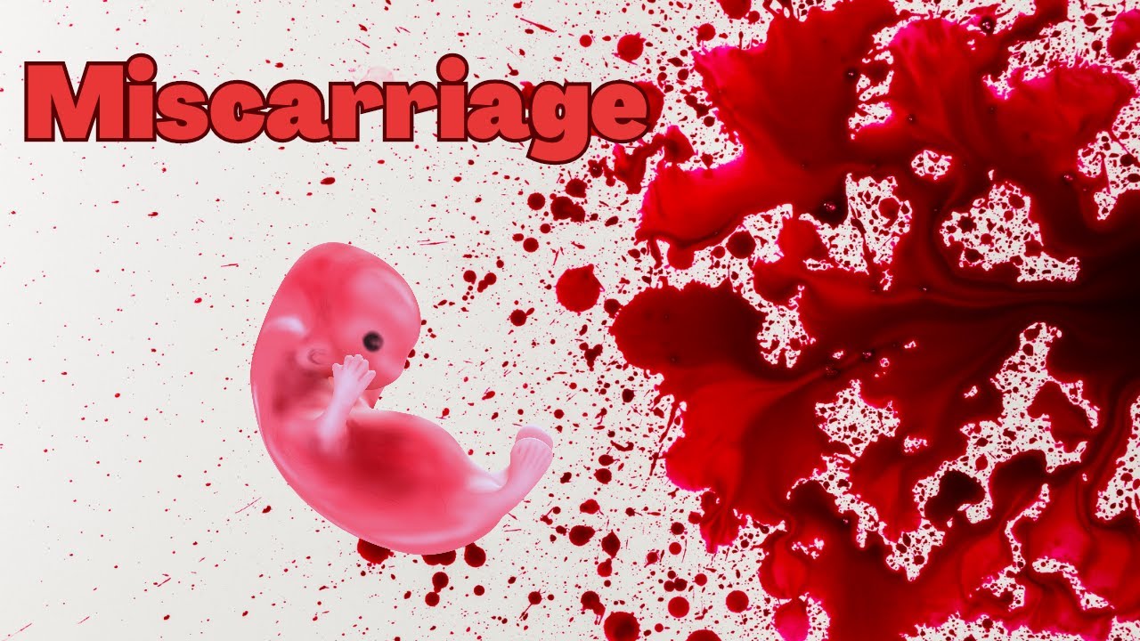Miscarriage: causes, symptoms, diagnosis and treatment. - YouTube