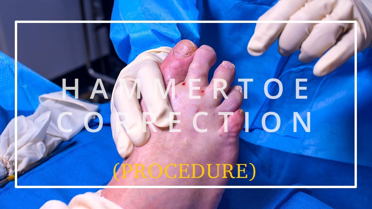 Fixing Hammer Toe: Minimally Invasive Procedure - YouTube