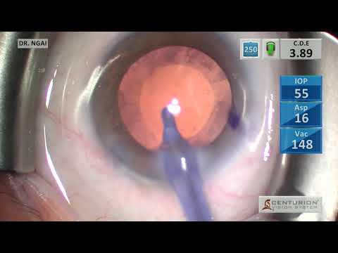 Dr. Philip Ngai 2022 02 17 104535 CEIOL + OMNI (180x2) + Hydrus OS ...