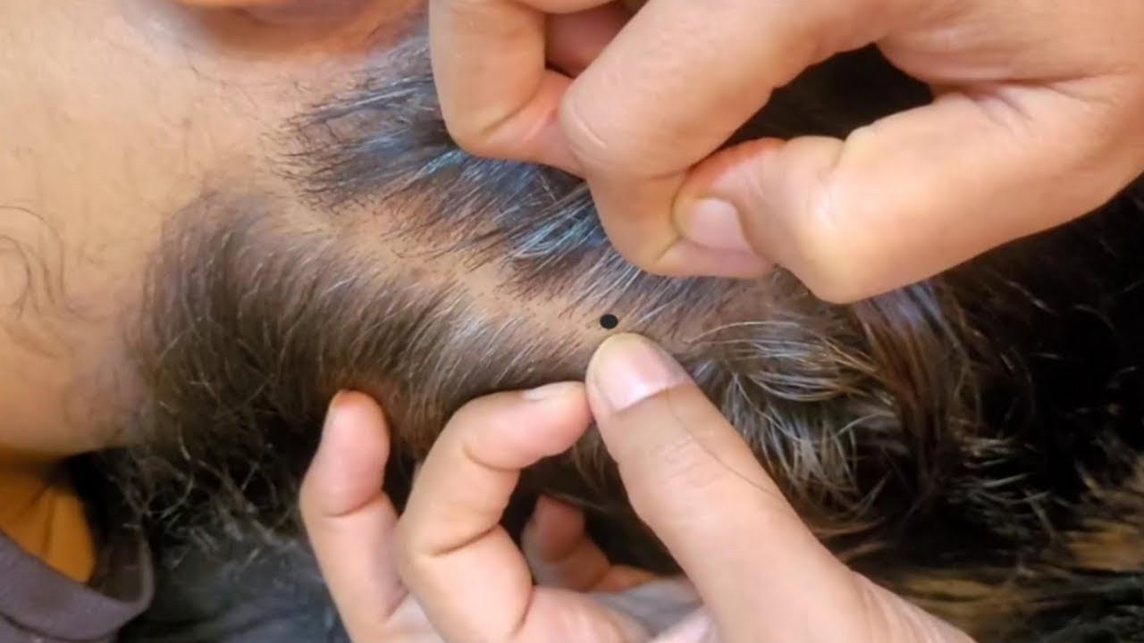 ASMR Tingly Scalp Check & Medical Roleplay, Lice Check & Scalp Massage ...