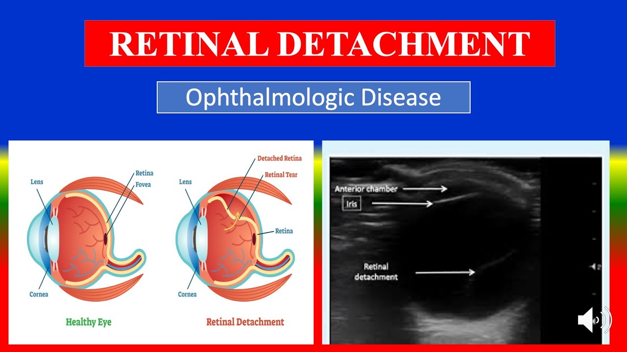 RETINAL DETACHMENT - Definition, types, causes, pathophysiology, signs ...