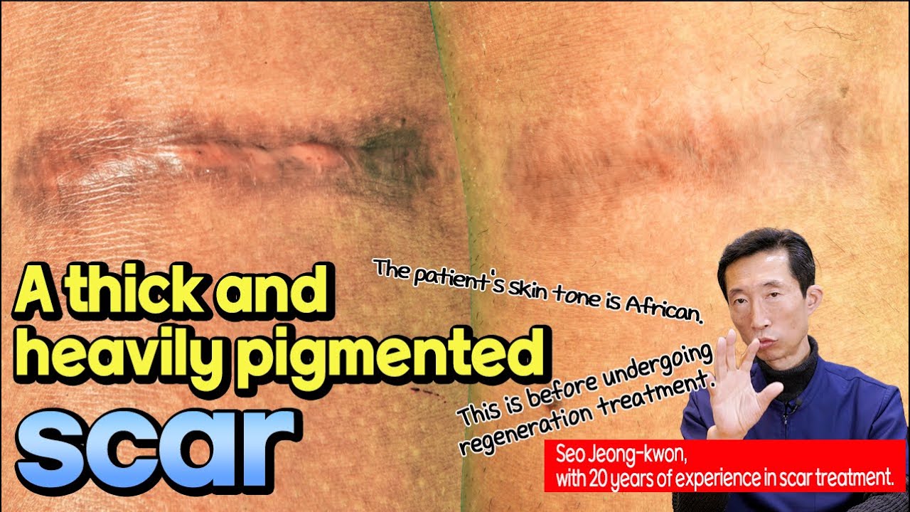 I can successfully treat scars on Black skin as well. - YouTube