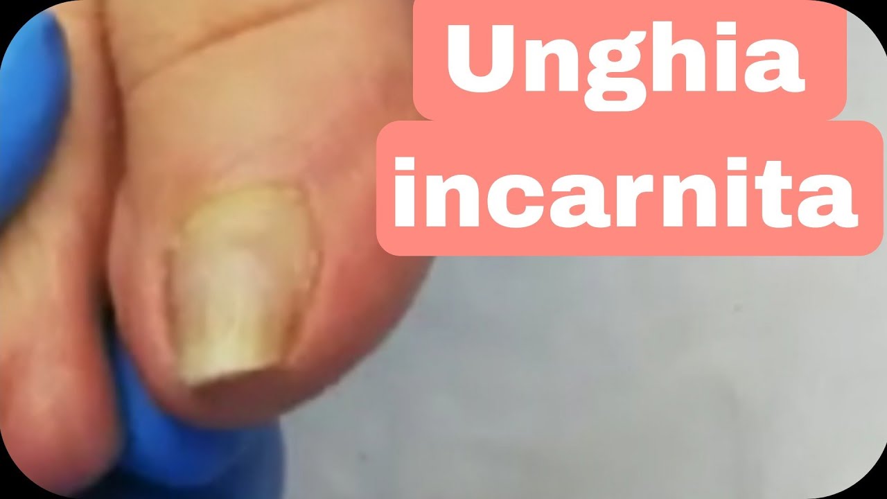 Unghia incarnita🤕guarda come ho liberato gli angoli. - YouTube