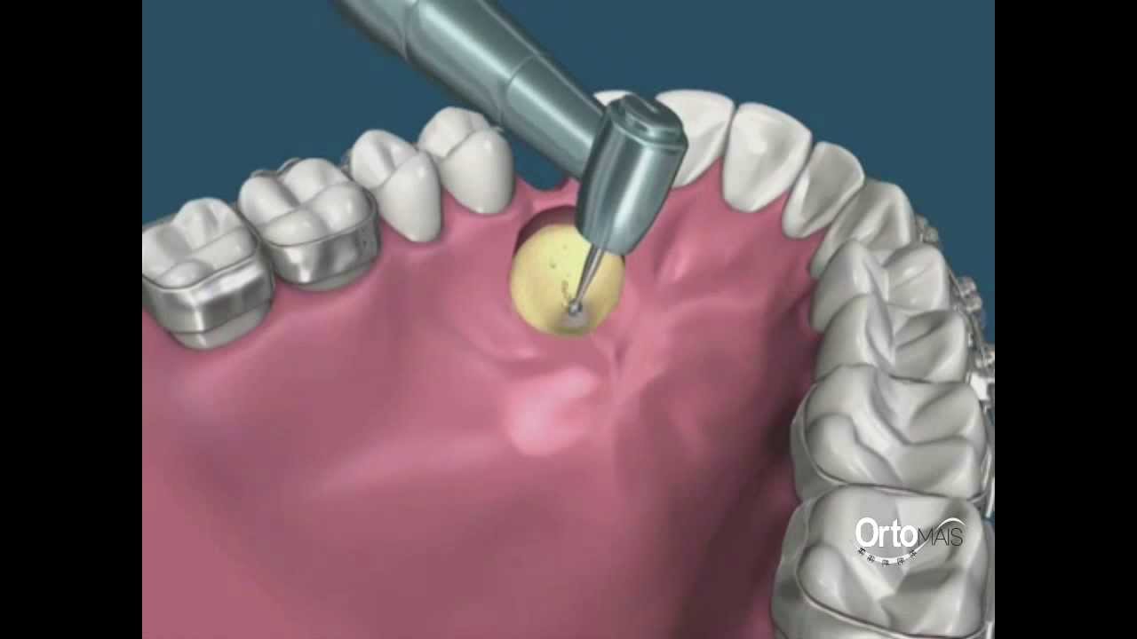Ortomais - Tracionamento de Dente Incluso - YouTube