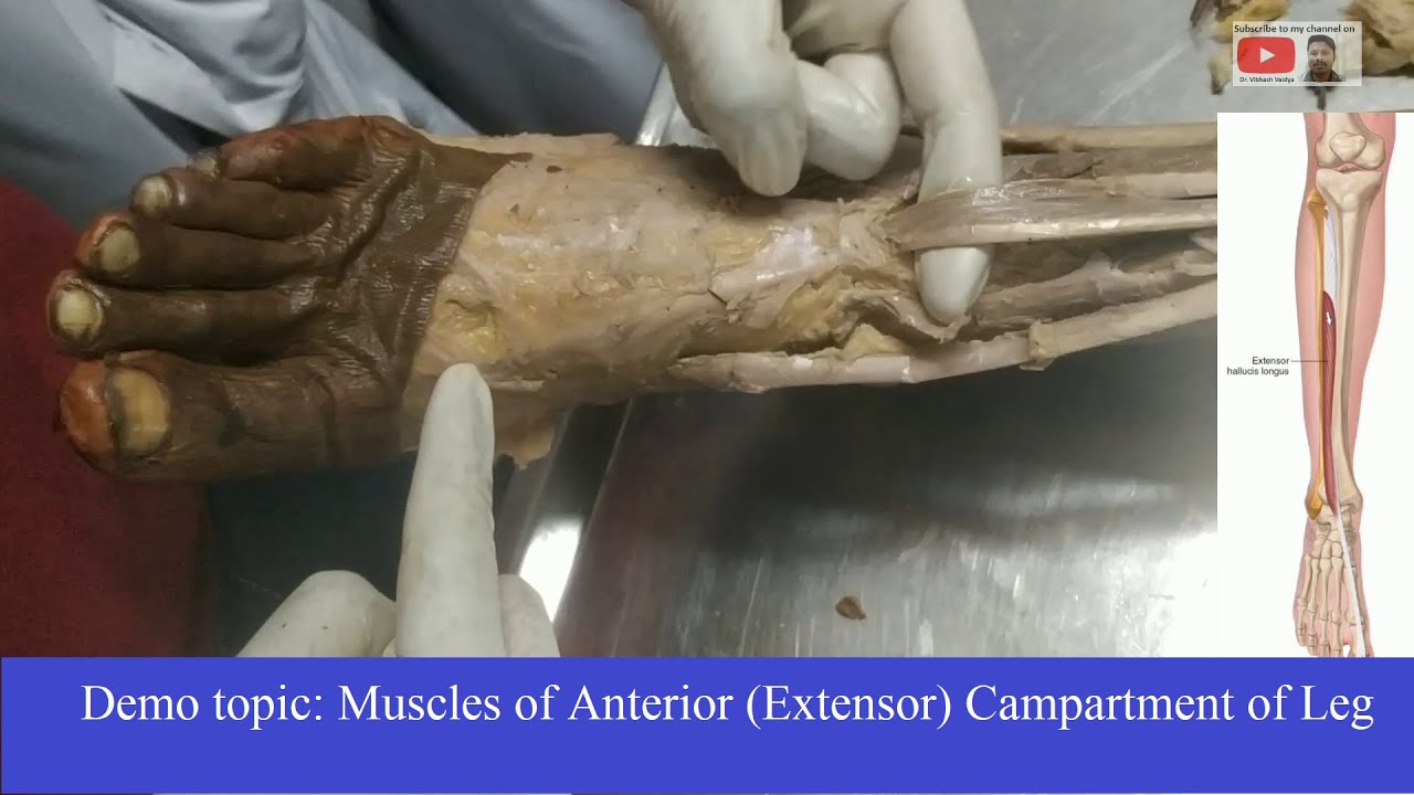Muscles of leg I I Anterior (extensors) Compartment of thigh I ...