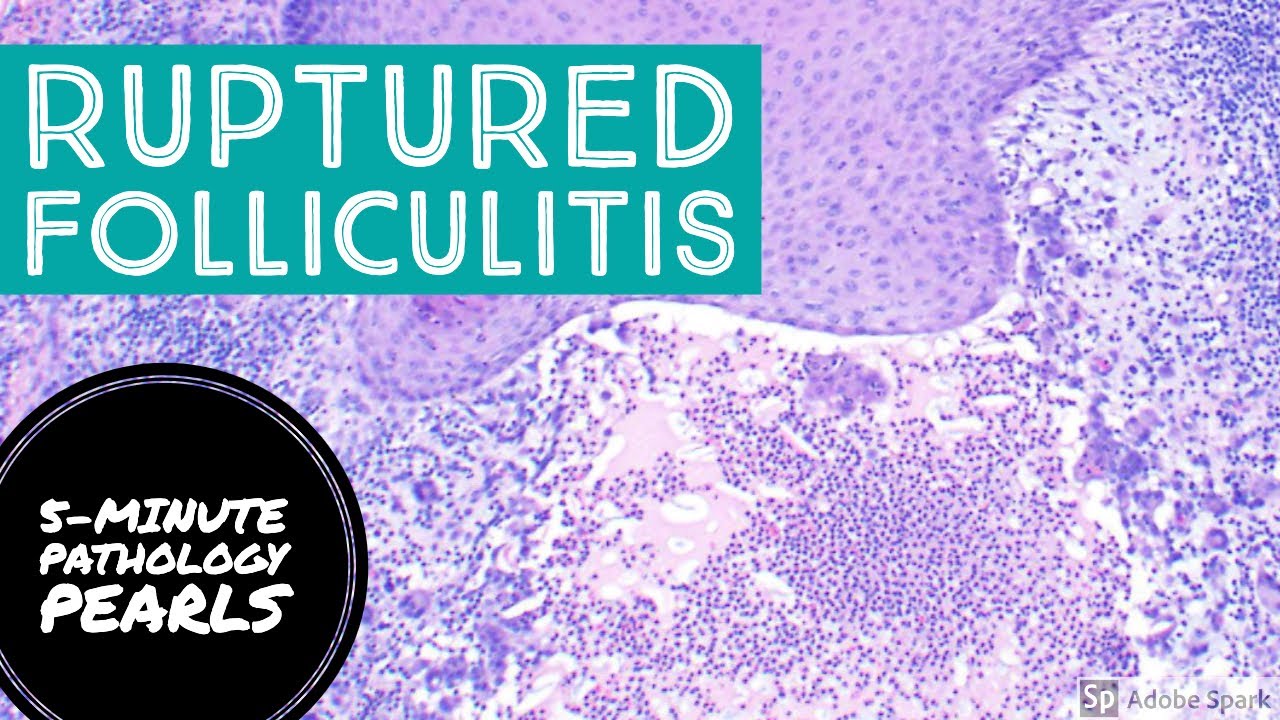 Ruptured Folliculitis, a Clinical Mimic of BCC: 5-Minute Pathology ...