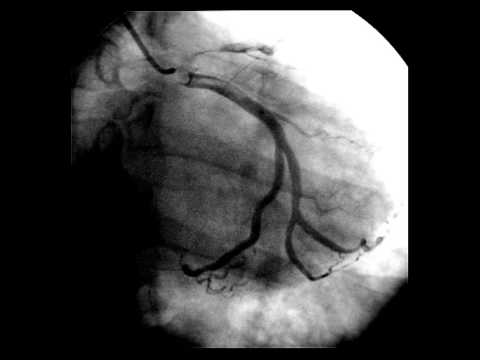 coronography - YouTube