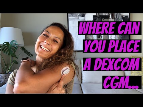 Where Can You Place a Dexcom CGM