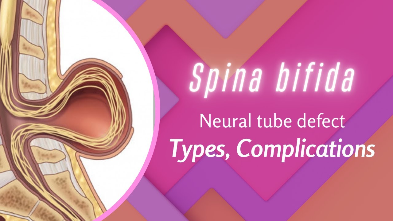 Spina Bifida Types, Complications - YouTube