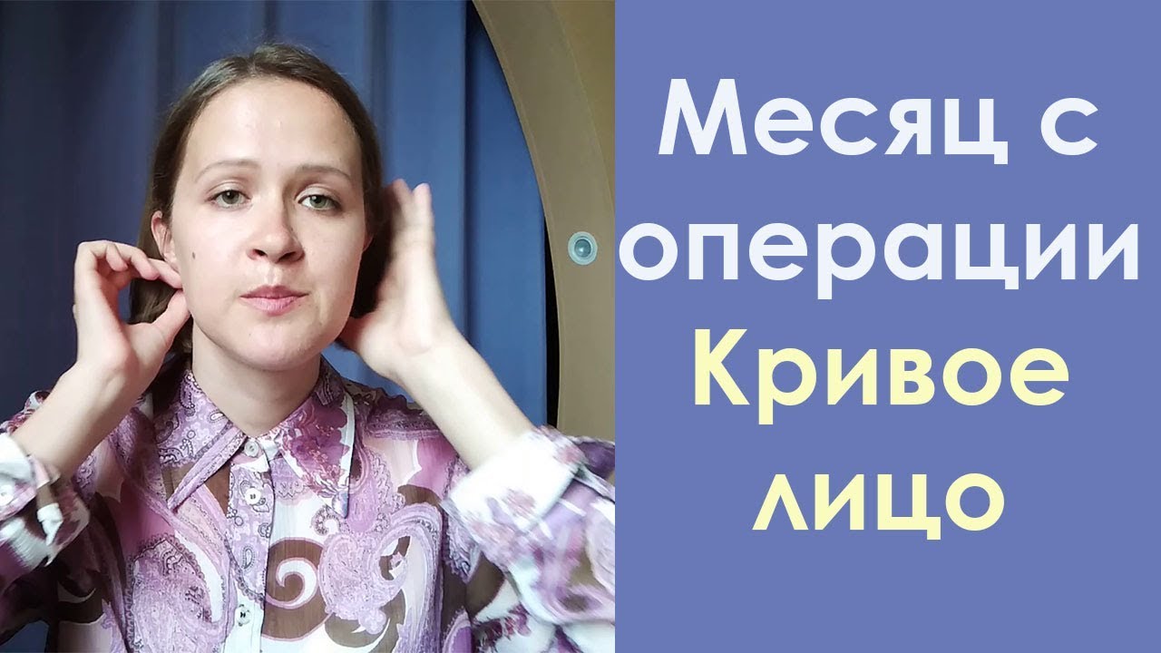 Кривое лицо. 1 месяц с операции - YouTube