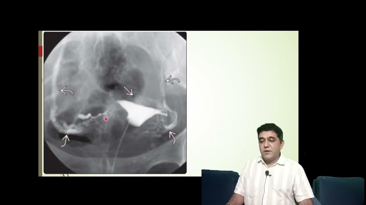 Hysterosalpingography spotters - YouTube