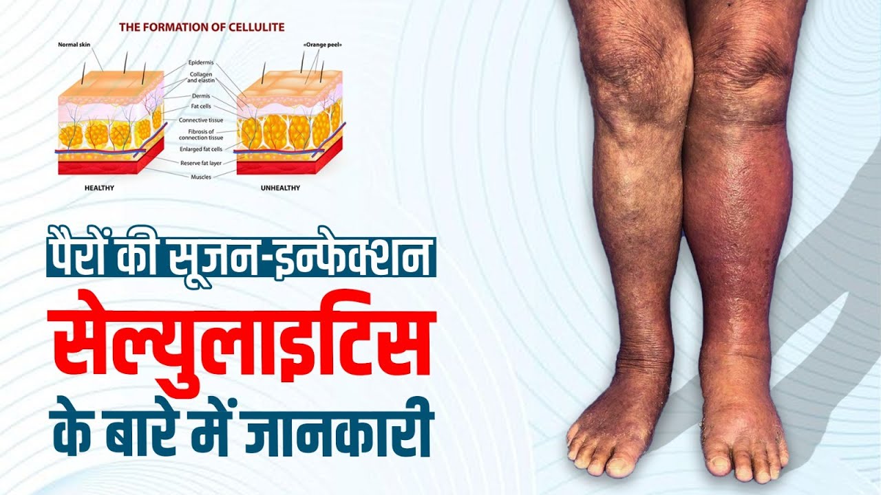 Leg Swelling & Infection? Everything You Need to Know About Cellulitis ...