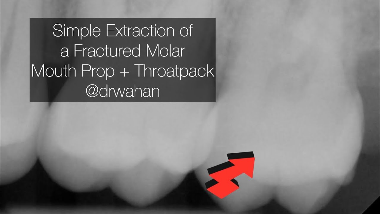 Placing a Throatpack for a Dental Extraction @drwahan - YouTube