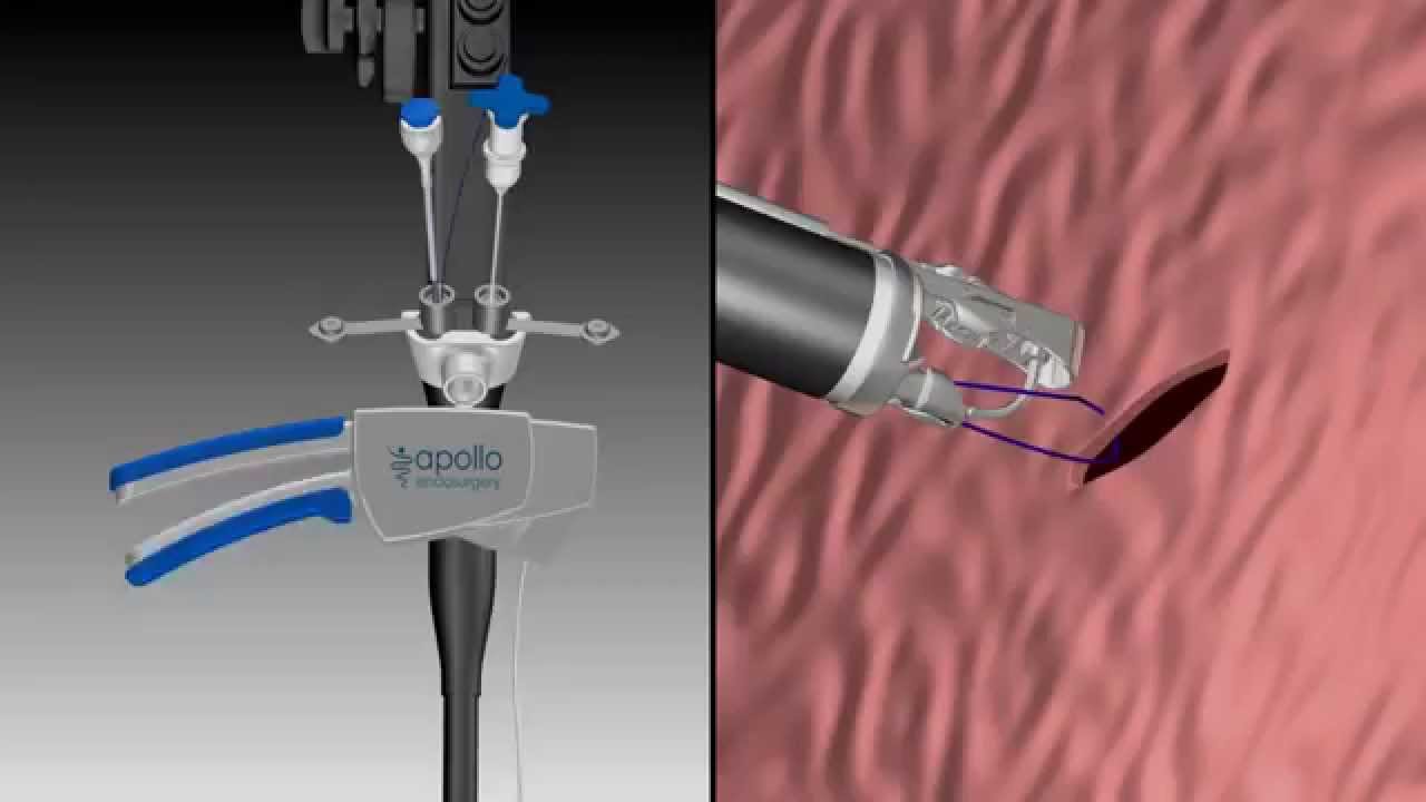 OverStitch Bariatric Surgery In Chicago - YouTube