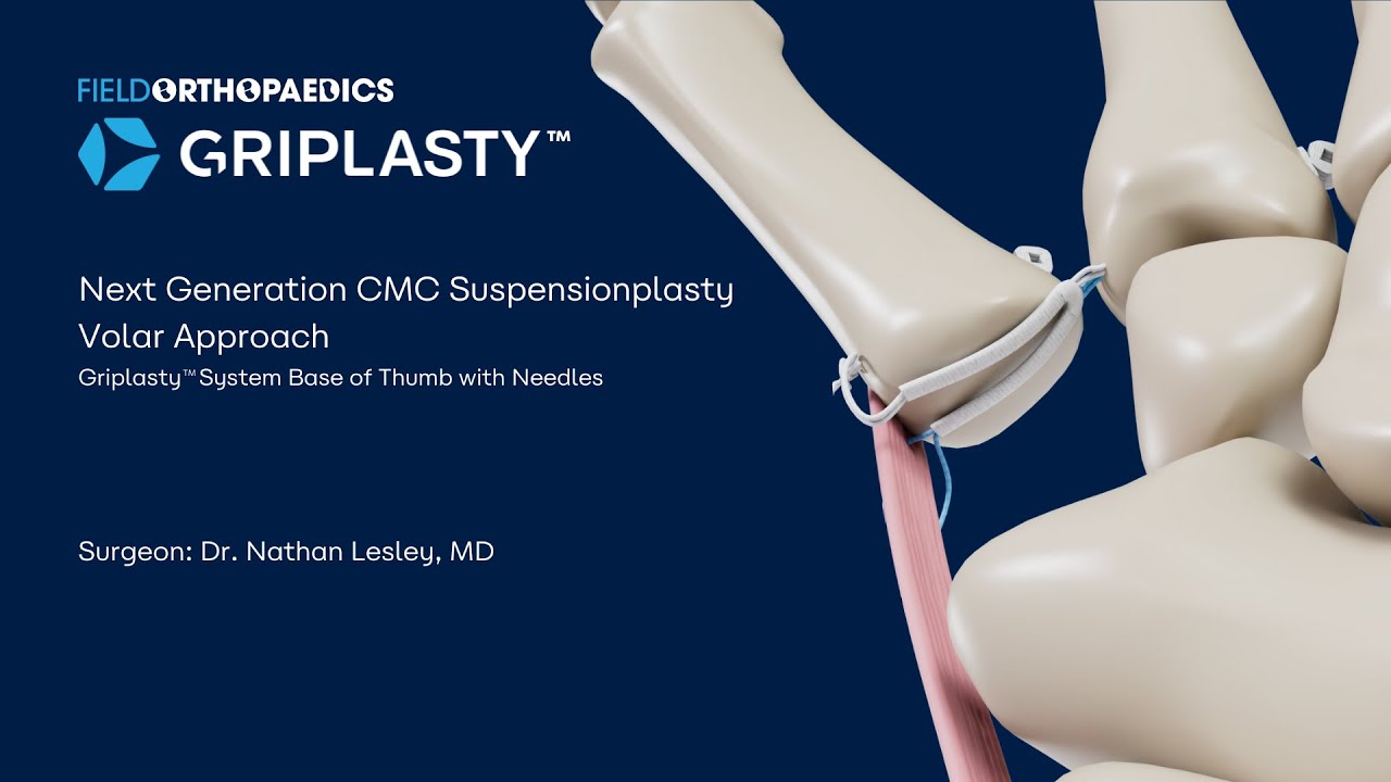 Griplasty System: Volar Surgical Approach for CMC Suspensionplasty by ...
