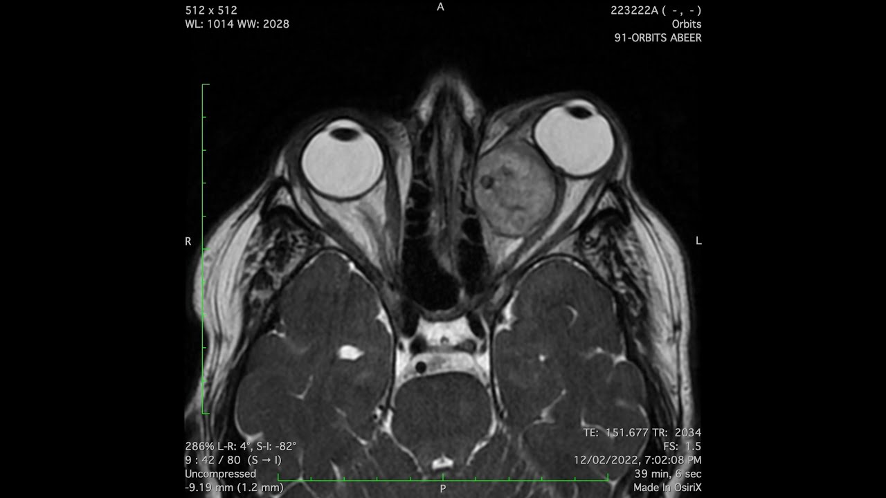 Medial Trans-conjunctival Orbitotomy For Orbital Tumor - YouTube