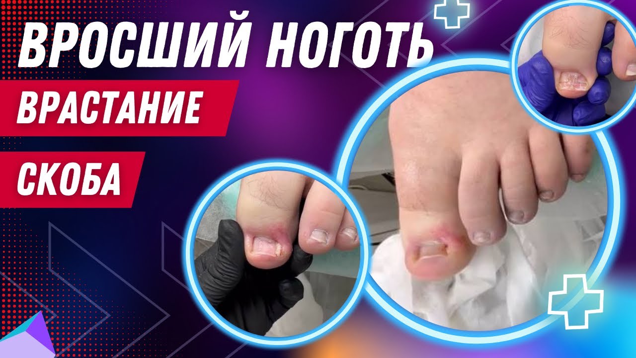 ВРОСШИЙ НОГОТЬ / врастание / скоба / Что нужно сделать? #скоба # ...