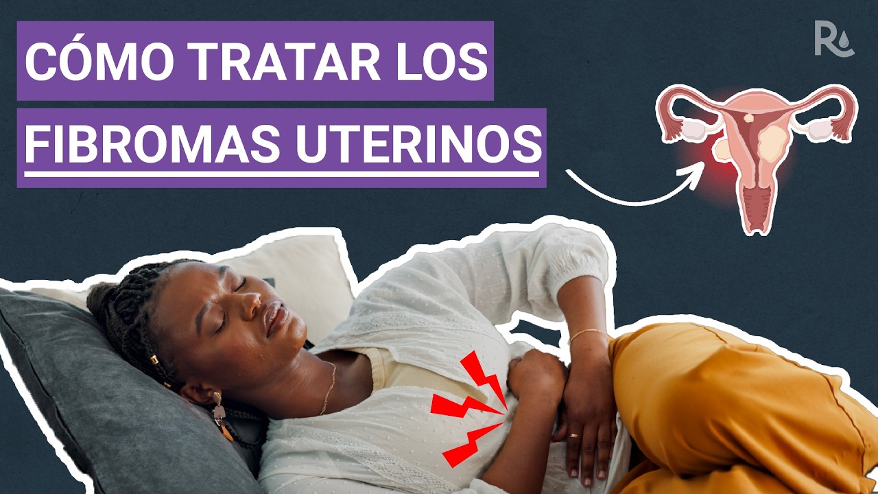 Fibromas uterinos: ¿Cuáles son los síntomas y las opciones de ...