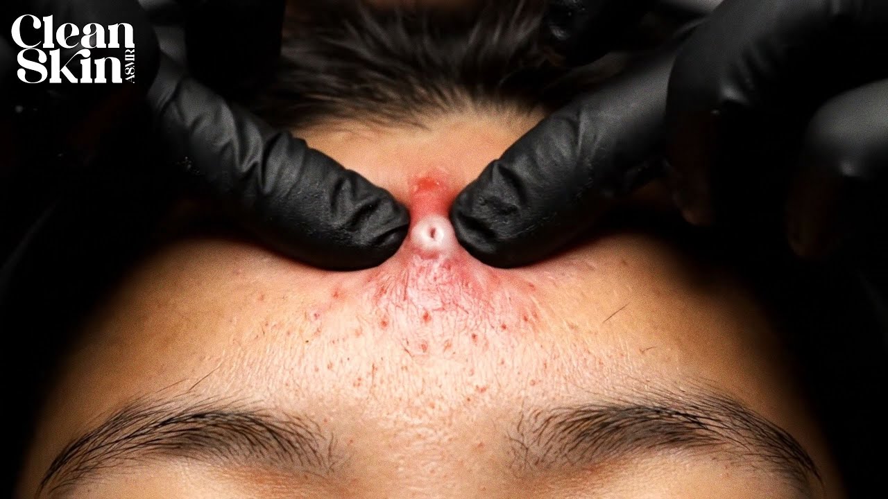 Massive Blackhead Removal — Real-Time ASMR Extraction 🤯 - YouTube