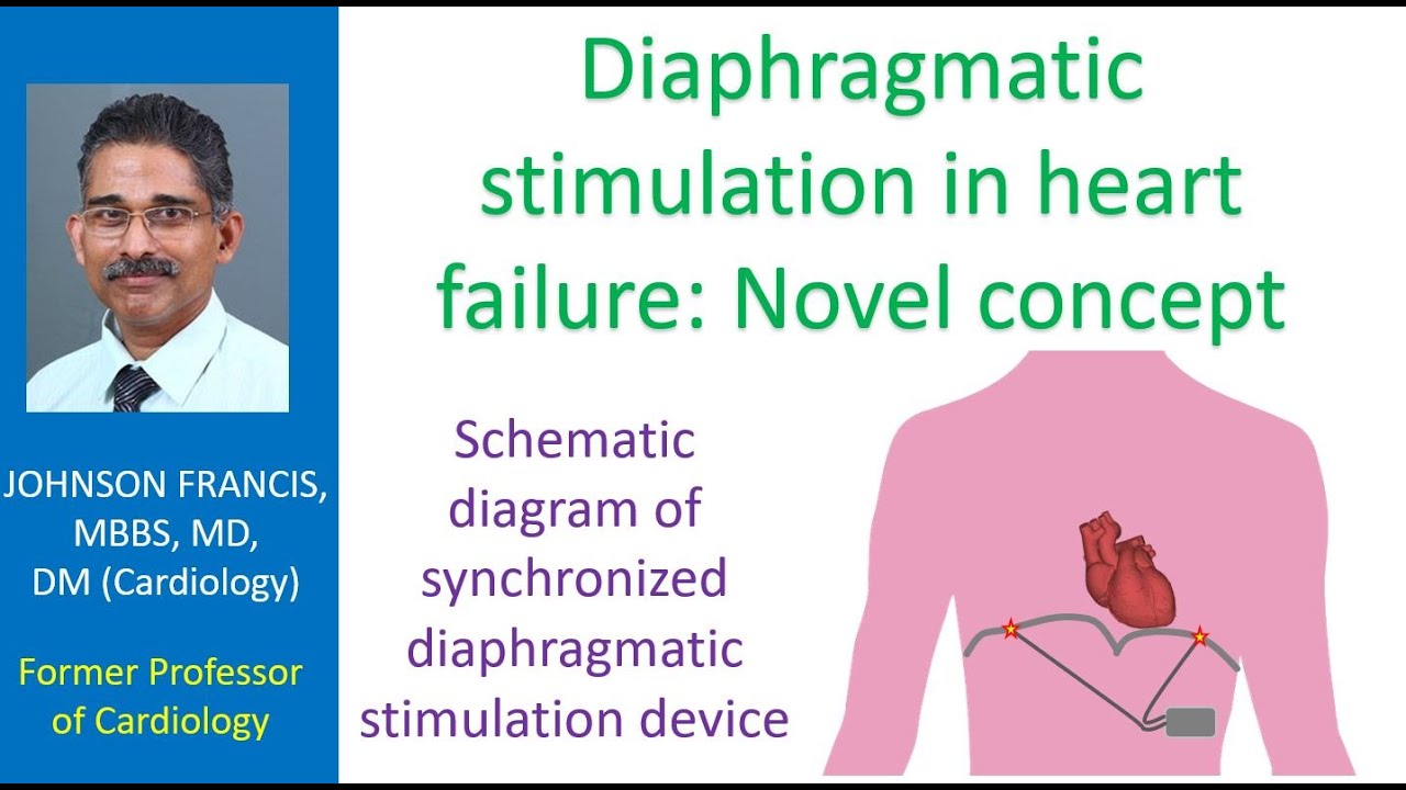 Diaphragmatic stimulation in heart failure: Novel concept - YouTube