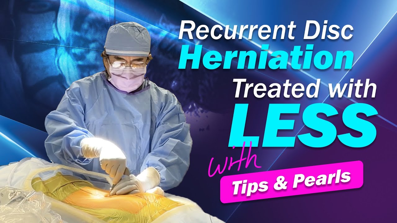 52-Year-Old with Recurrent Disc Herniation | LESS discectomy - YouTube