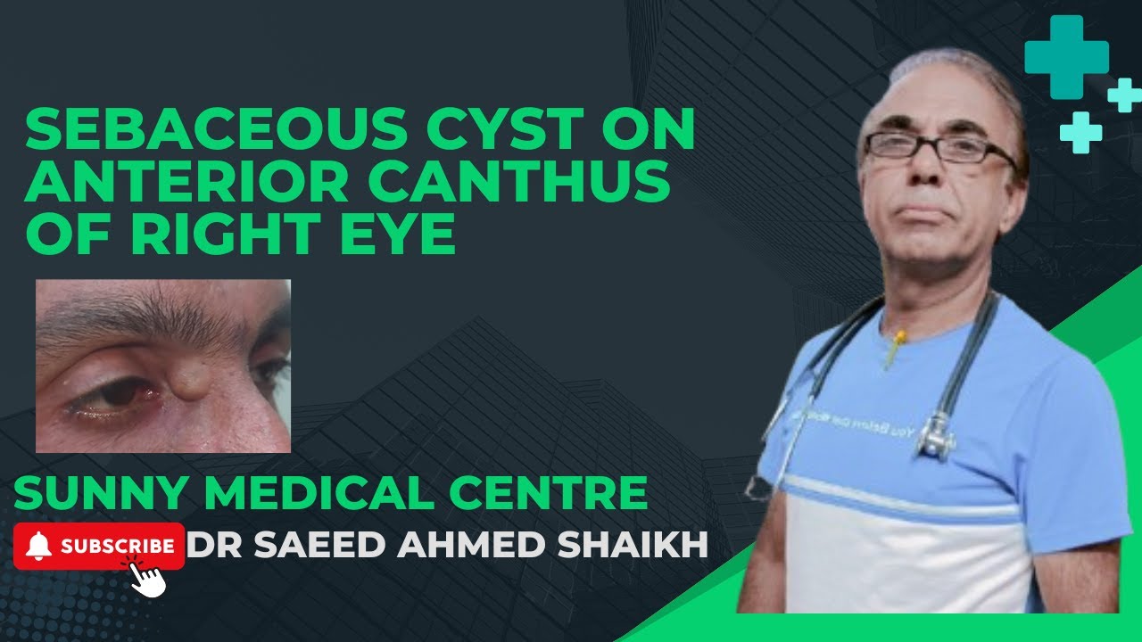 Sebaceous Cyst on Medial Canthus of Right Eye | Symptoms & Treatment ...