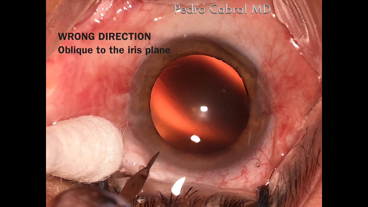 Accessory incision (paracentesis) for cataract surgery - step by step ...
