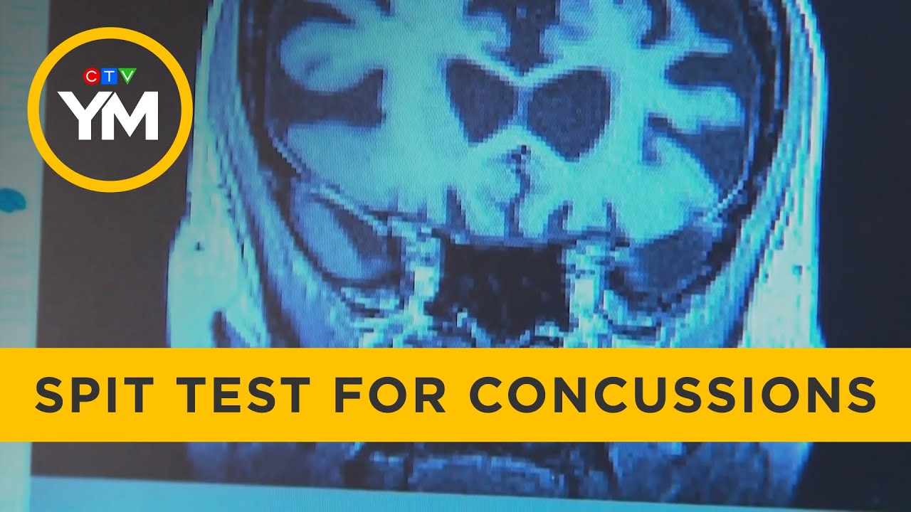 New Spit Test Hopes to Detect Concussions | Your Morning - YouTube