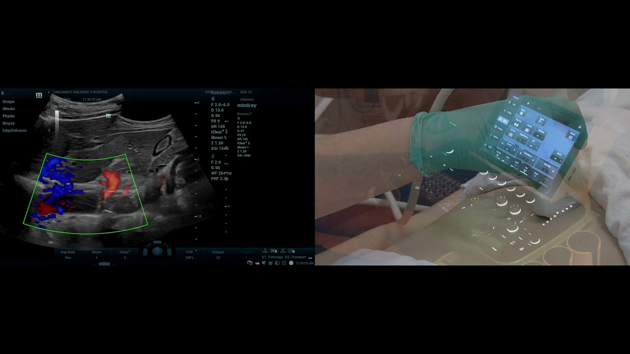 Using Ultrasound Heel Toe Technique - YouTube