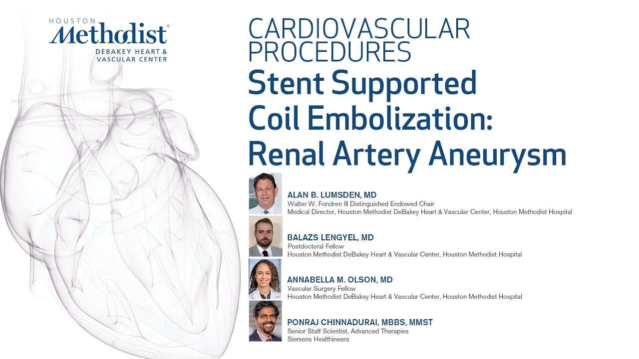 Stent-supported coil embolization: Renal Artery Aneurysm (A Lumsden MD ...