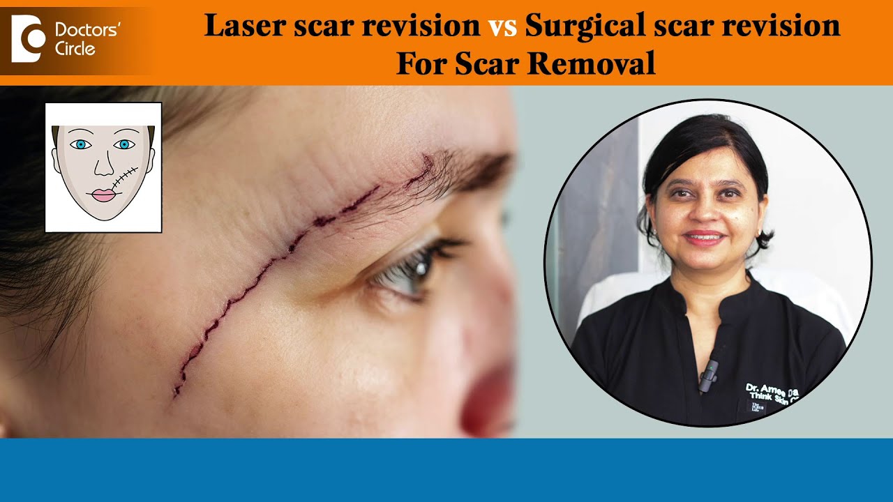 BEST SCAR REMOVAL - Laser scar revision vs Surgical scar revision - Dr ...