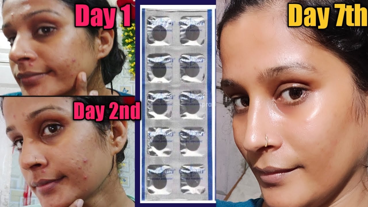 Most effective pimples, acne face pack || Treatment of acne & pimples ...