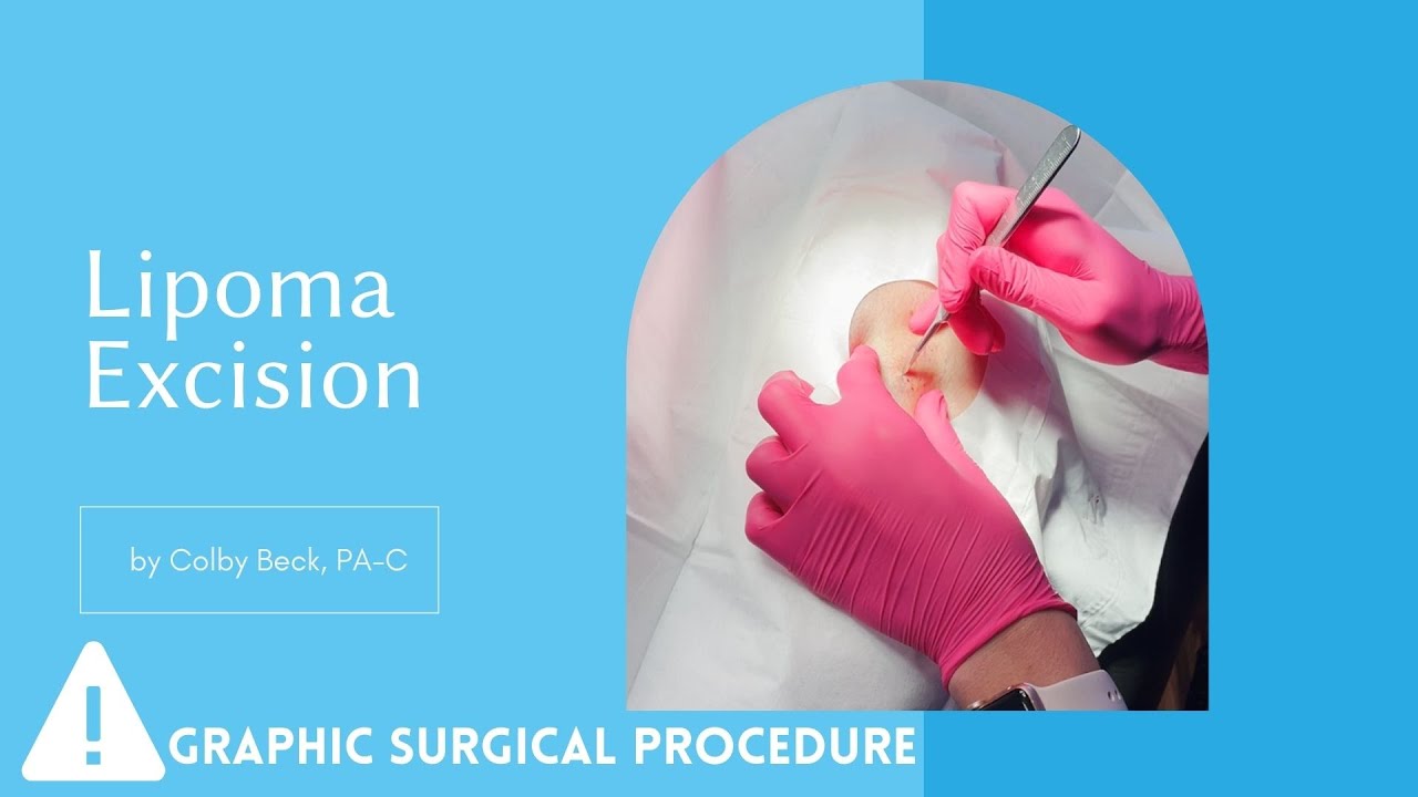 Lipoma Excision- Colby Beck, PA-C - YouTube