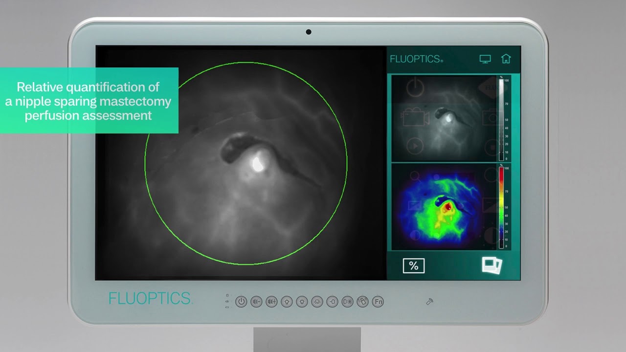 FLUOBEAM® IN ACTION - Plastic and reconstructive surgery - Breast ...
