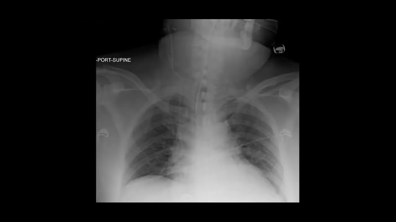 Central Line Anchoring Clips - YouTube