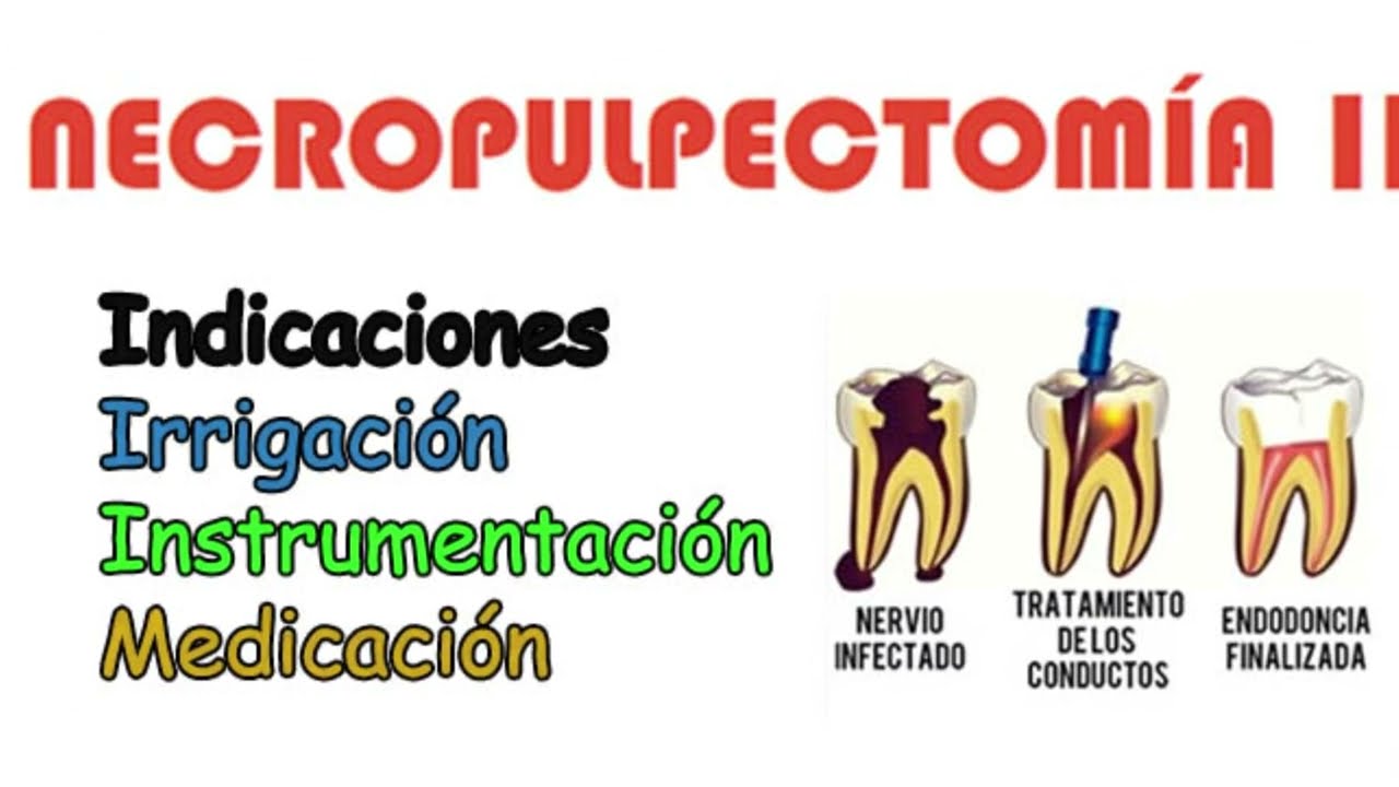 ENDODONCIA - NECROPULPECTOMIA II / Indicaciones, Irrigación ...