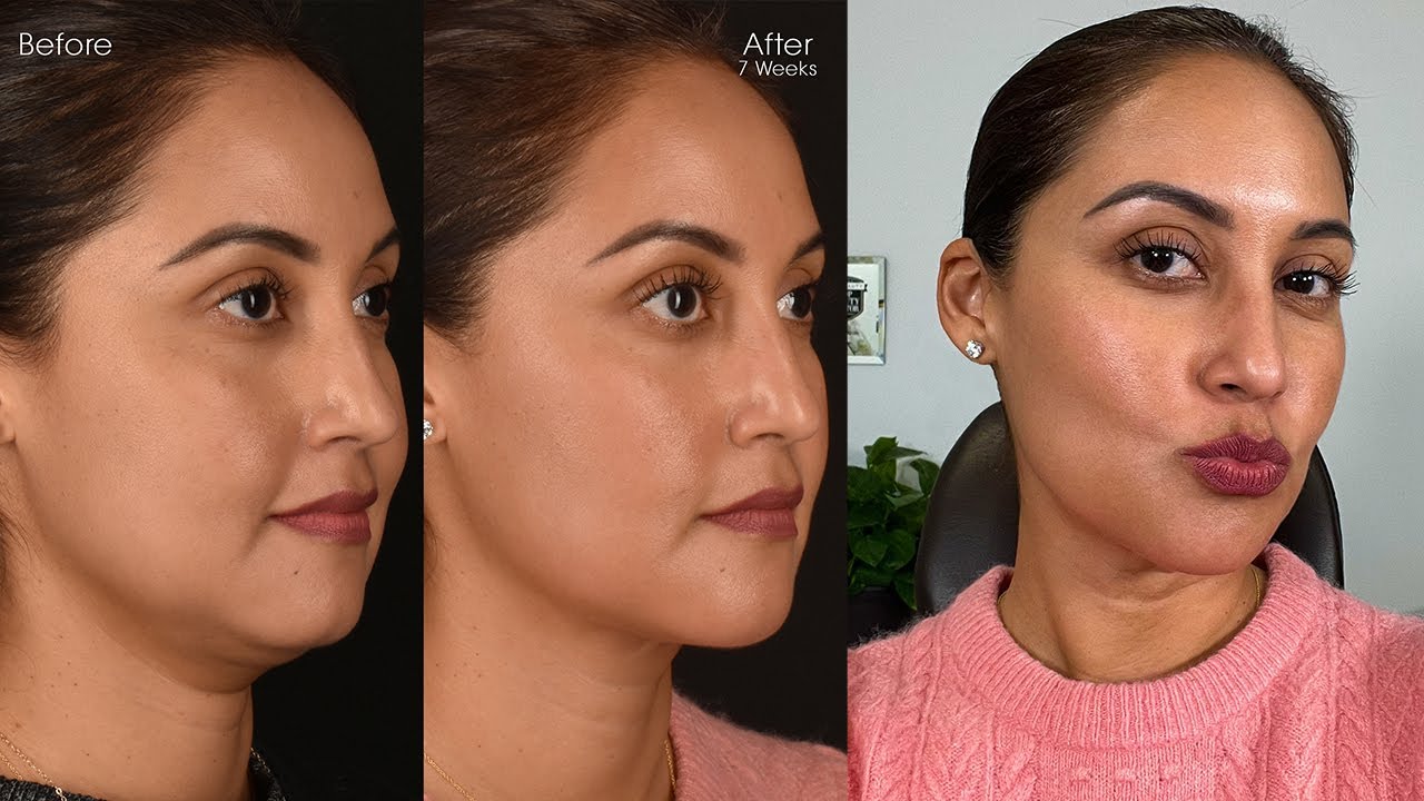 Julia's Facial Slimming Results | Deep Neck Liposuction, Buccal Fat ...