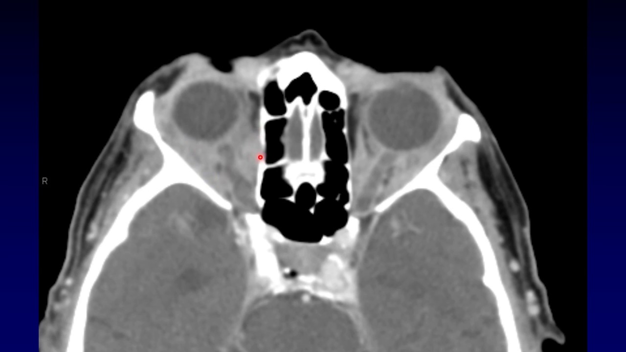 Imaging of the Eye and Orbit, Part 4 - YouTube