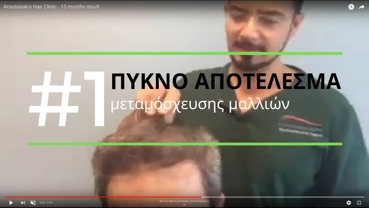 👍Case #92 - Δείτε το 100% ΦΥΣΙΚΟ & ΠΥΚΝΟ ΑΠΟΤΕΛΕΣΜΑ! Μεταμόσχευση ...