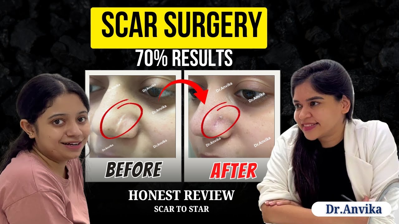 Successful Trauma Scar Surgery ll Before After ll #dranvika #skincare ...