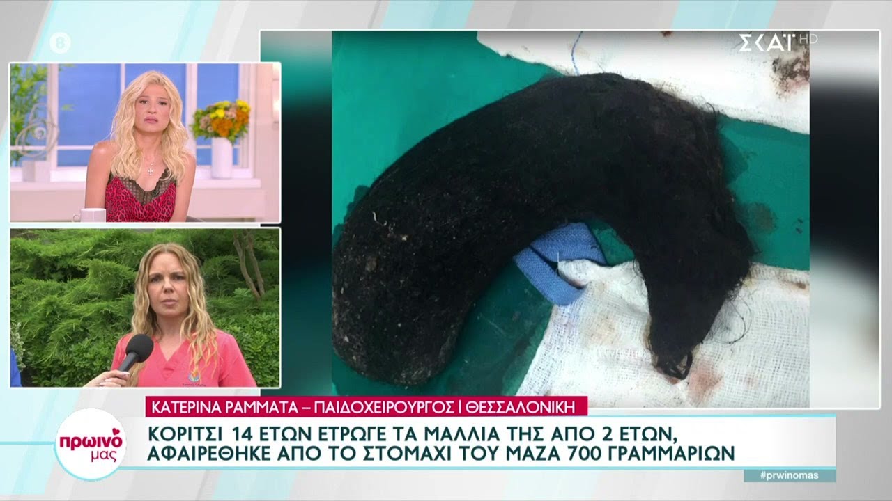 Τι λέει η χειρούργος που βρήκε και αφαίρεσε την μάζα μαλλιών από ...