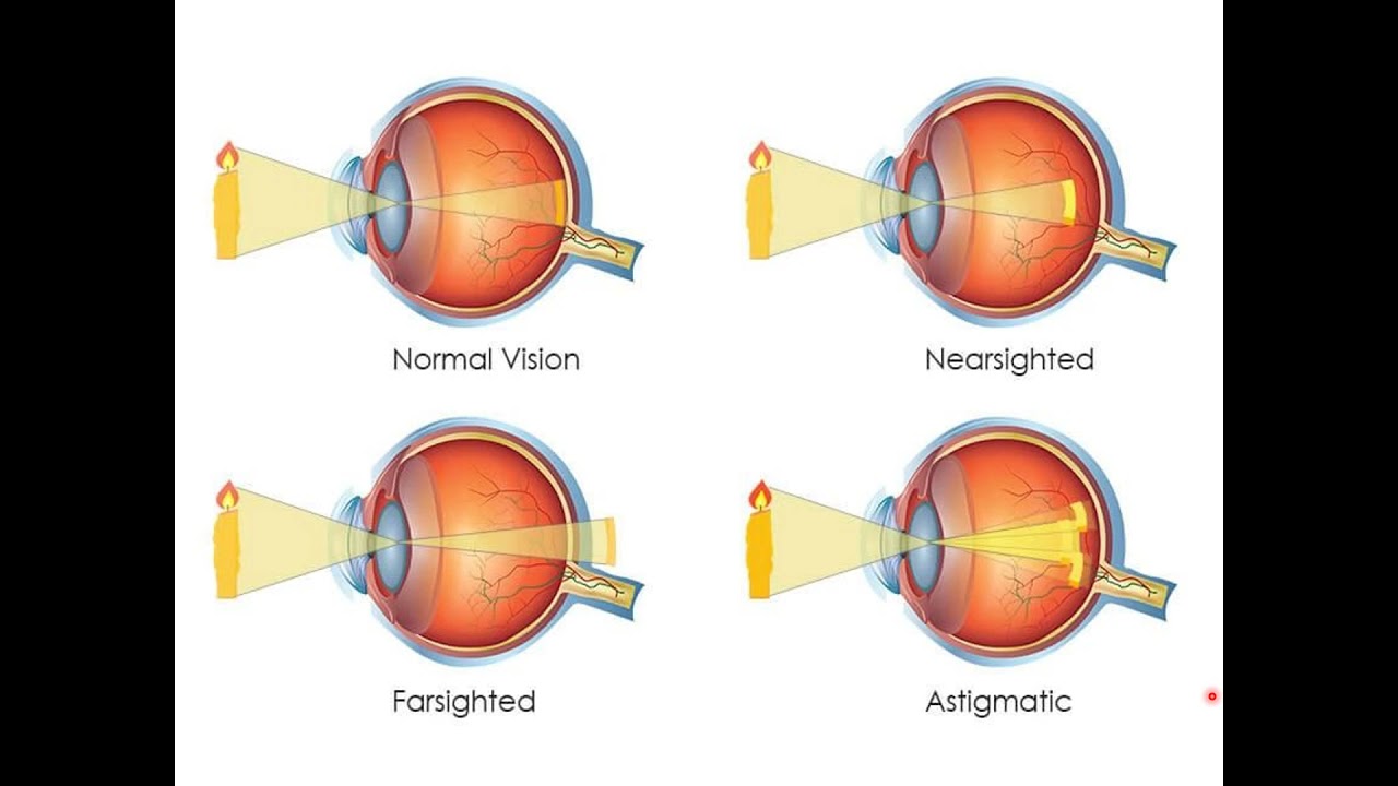 Eyes and Vision Assessment - YouTube