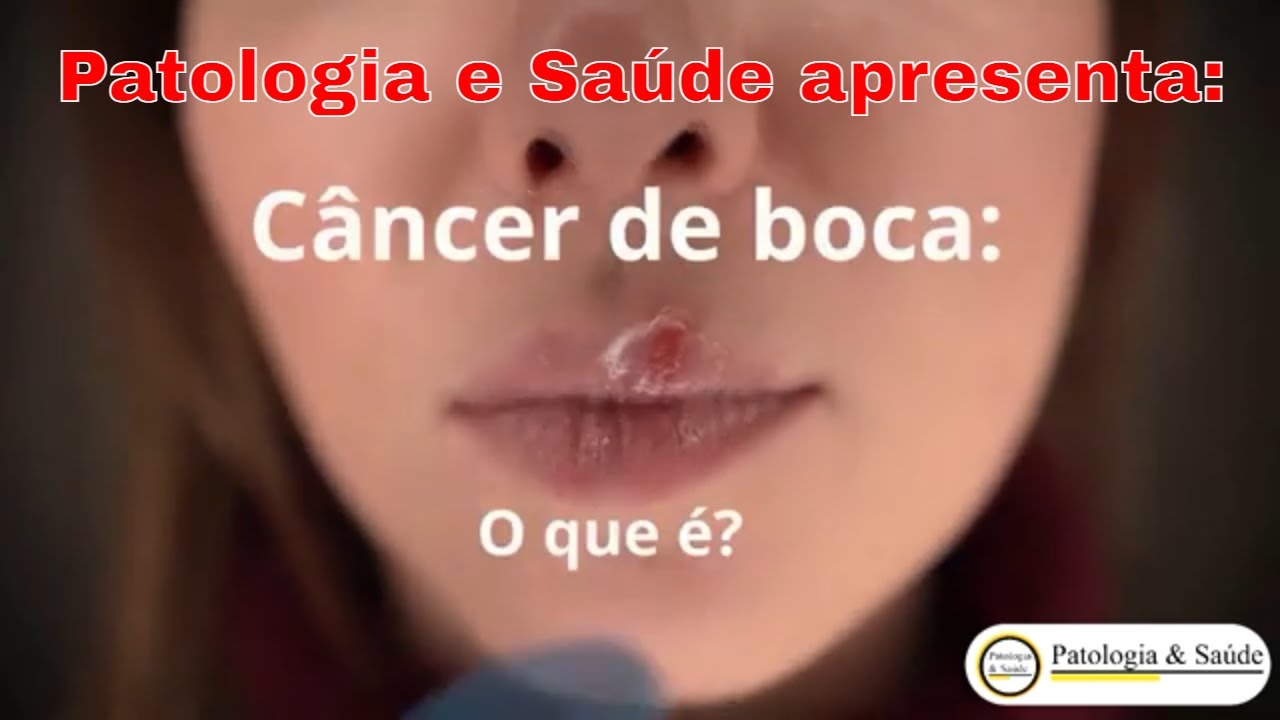Câncer de boca: o que é e como se prevenir? - YouTube