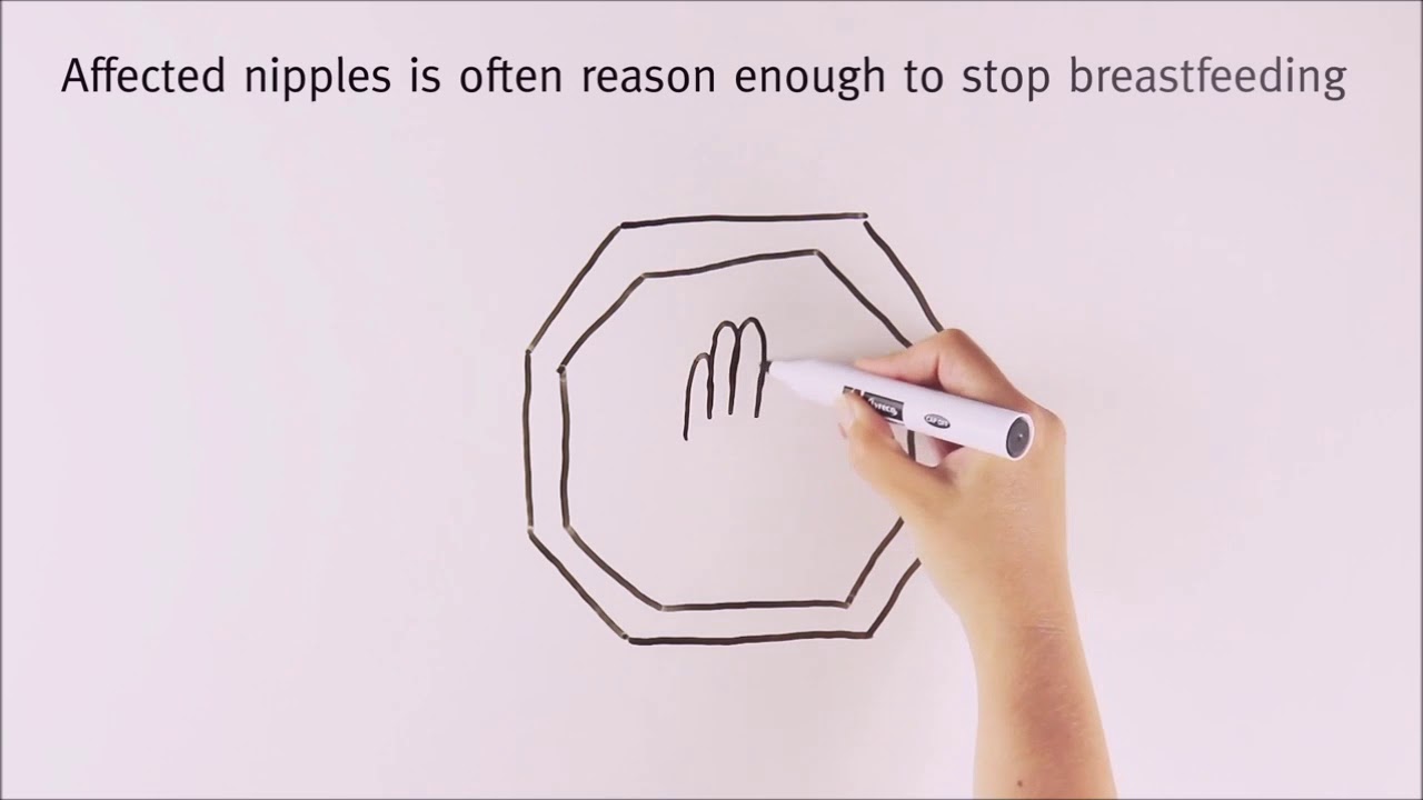 Compresses: Treatment For Breastfeeding Mums from Multi-Mam - YouTube