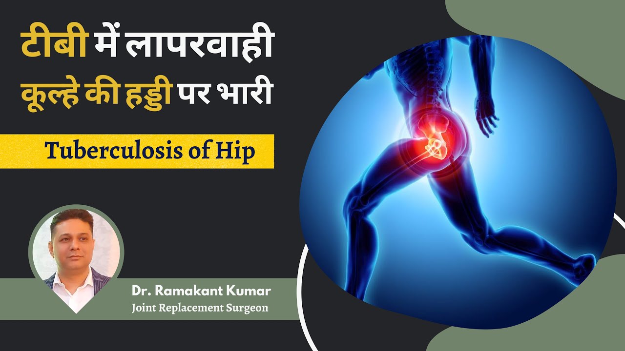 Tuberculosis of Hip : Symptoms and Treatments | Hip Tuberculosis | Dr ...