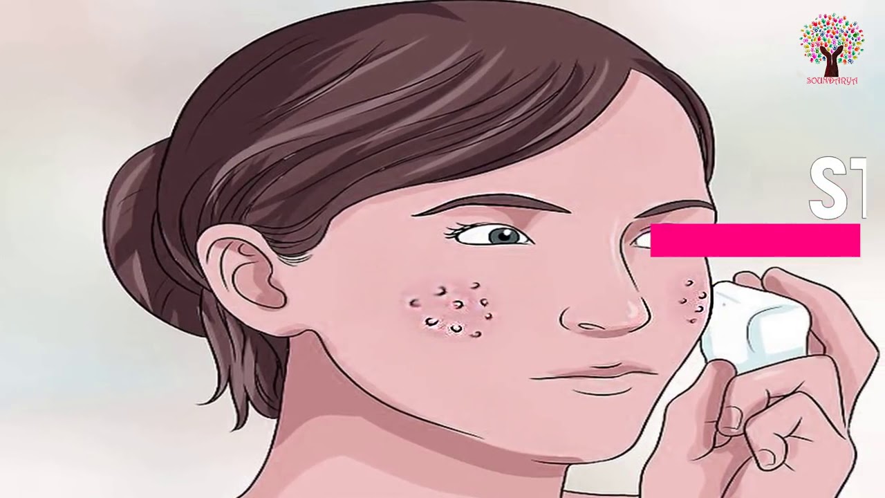 How to get rid of Large OPEN PORES permanently & Acne Scars NATURALLY ...
