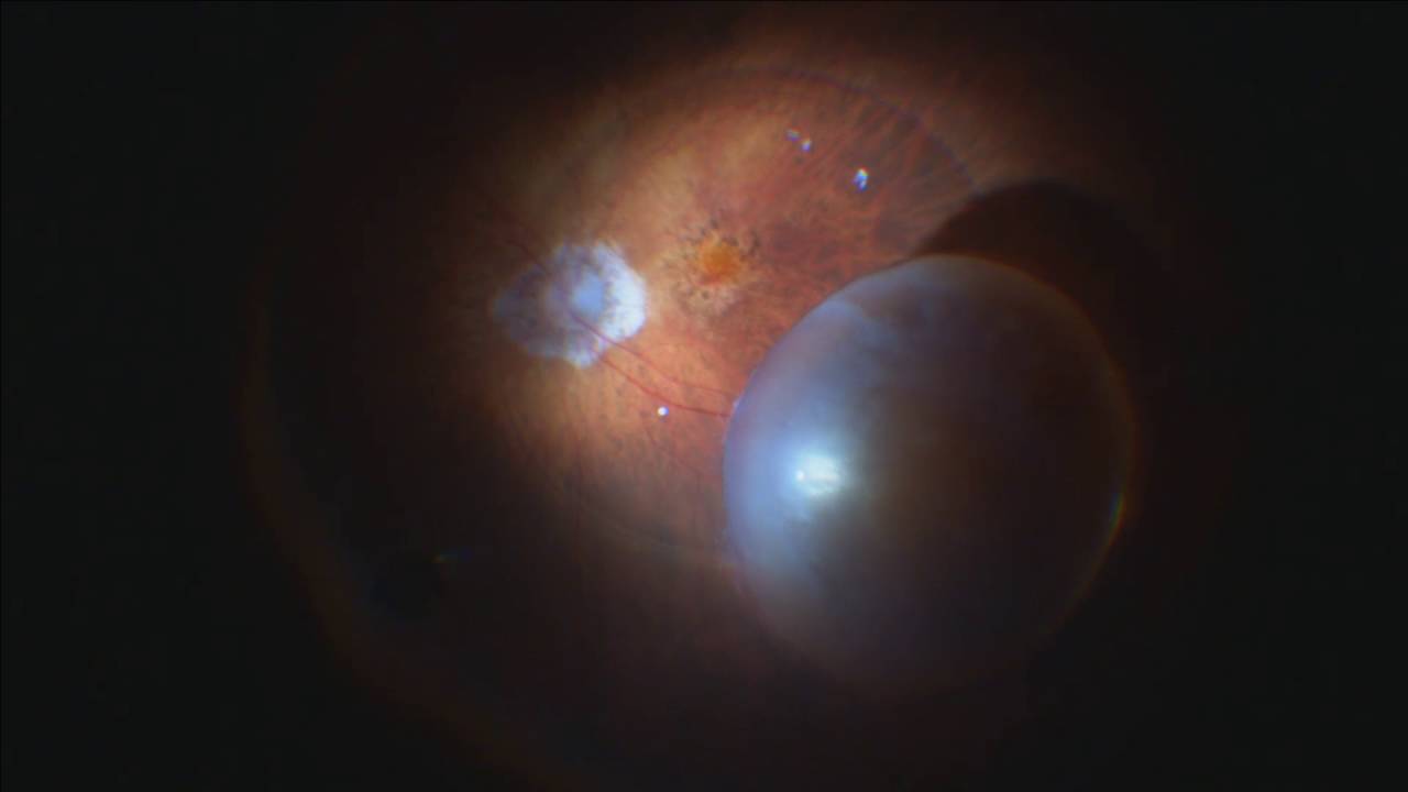 Luxated Brunescent cataract and Oculentis LU-814 VR Lukan Mishev Live ...