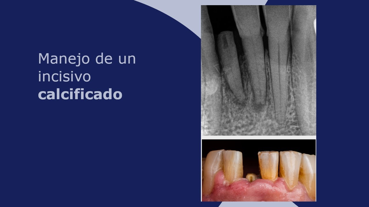 Manejo de un incisivo calcificado - YouTube