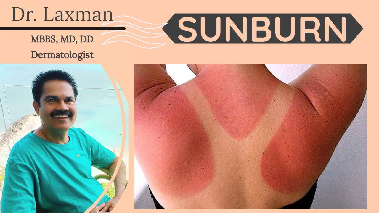 Sunburn Cause And Features What Causes Sunburn What Is Sunburn