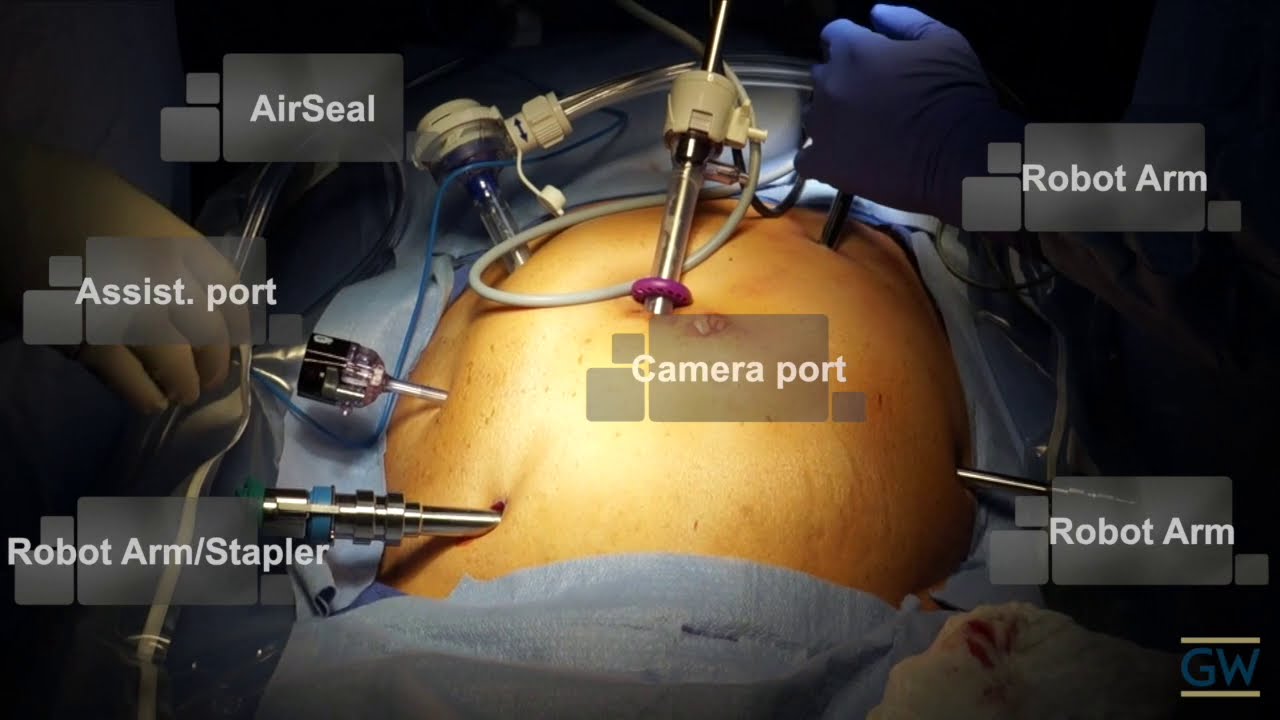 Robotic Left Hemicolectomy Utilizing All Three Robotic Arms - YouTube